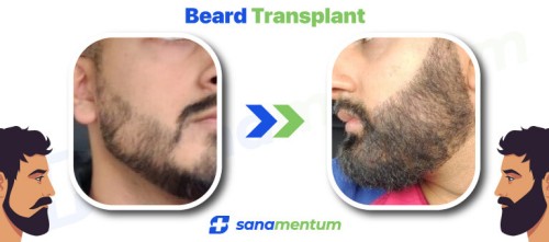 Beard Transplant In Turkey